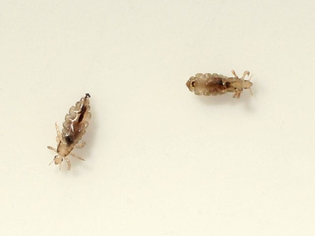 Head Lice in 25 States Resistant to Over-the-Counter Treatments