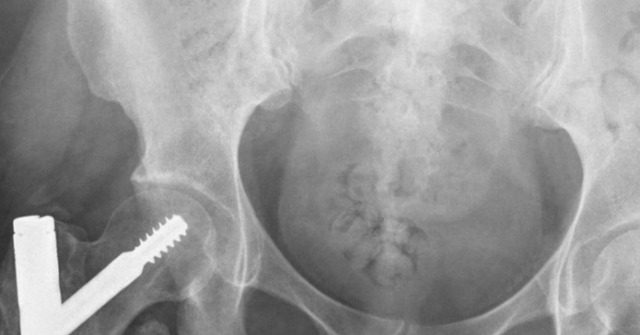 Endocrinologist Puberty Blockers Cause Huge Decrease In Bone Density 6959